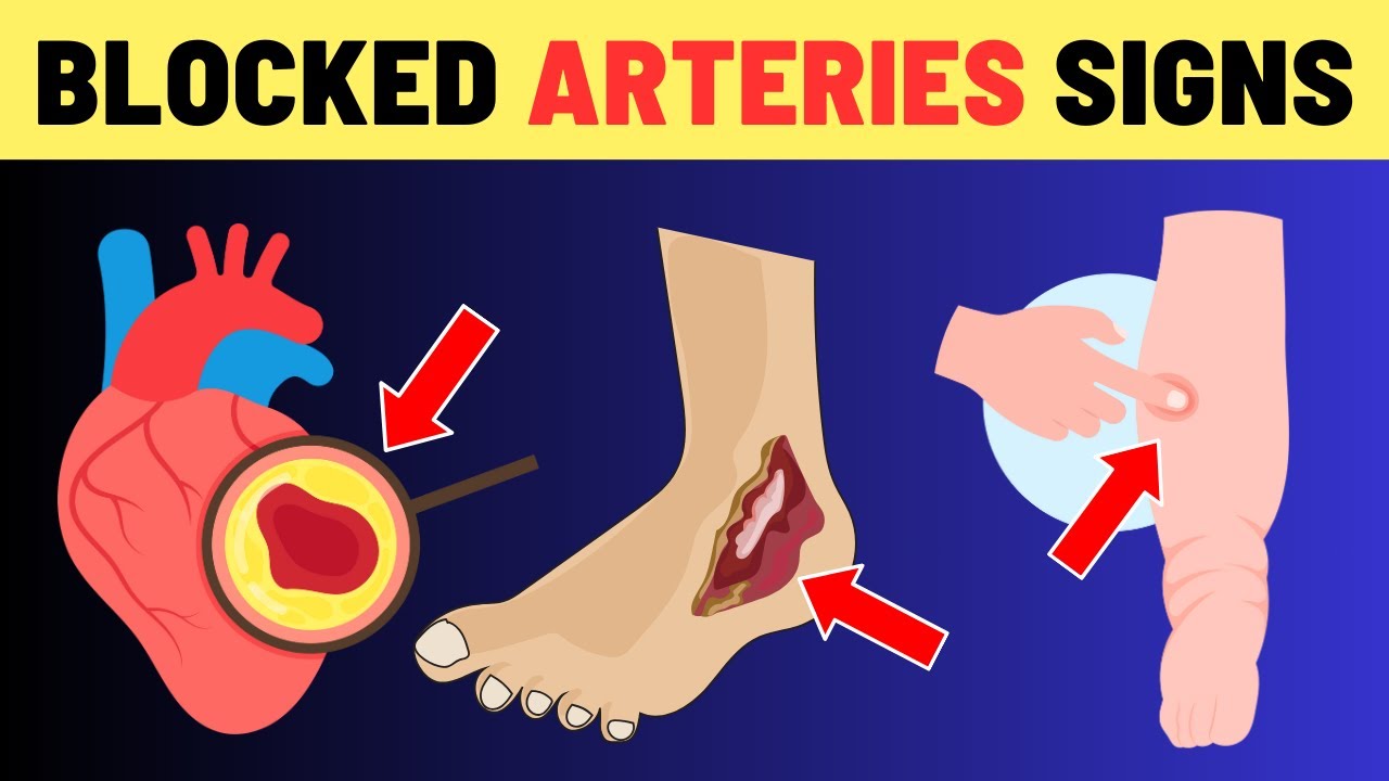 Symptoms of Clogged Arteries: What to Watch Out For - Cosmo Connects