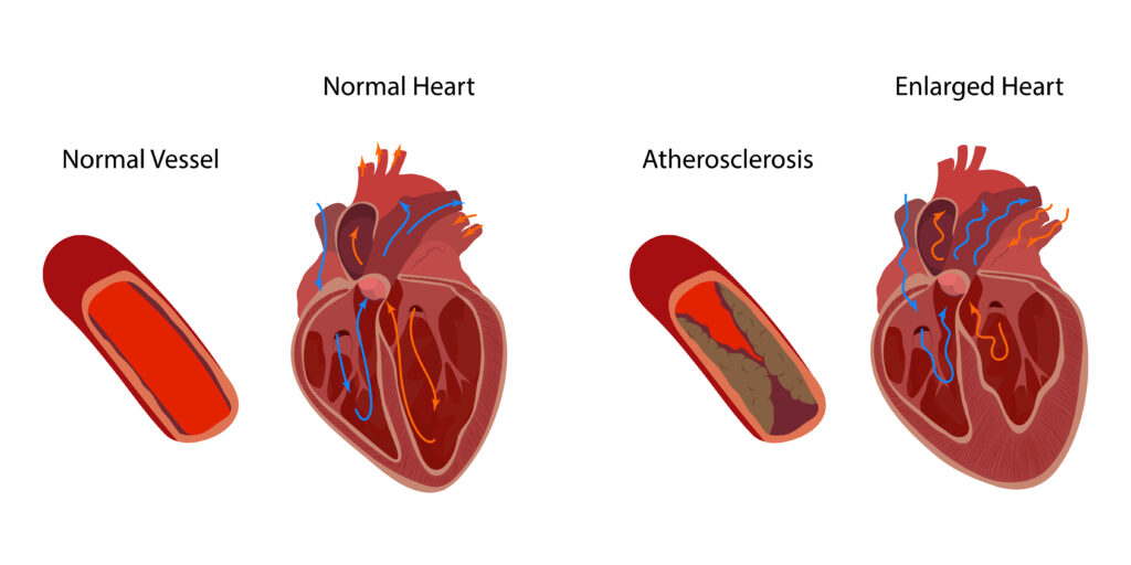 Enlarged Heart: Causes, Symptoms, and Treatment Options - Cosmo Connects